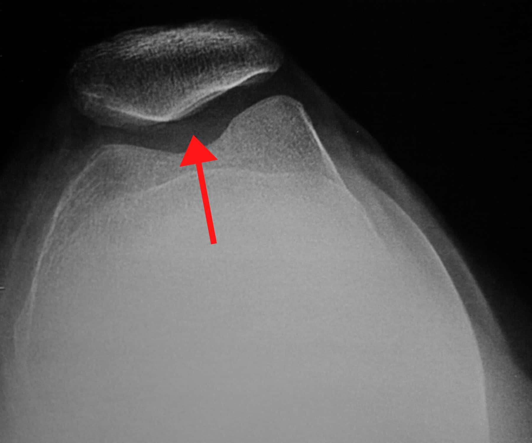 12 Best Exercises for Knee Pain Relief - PT Time with Tim